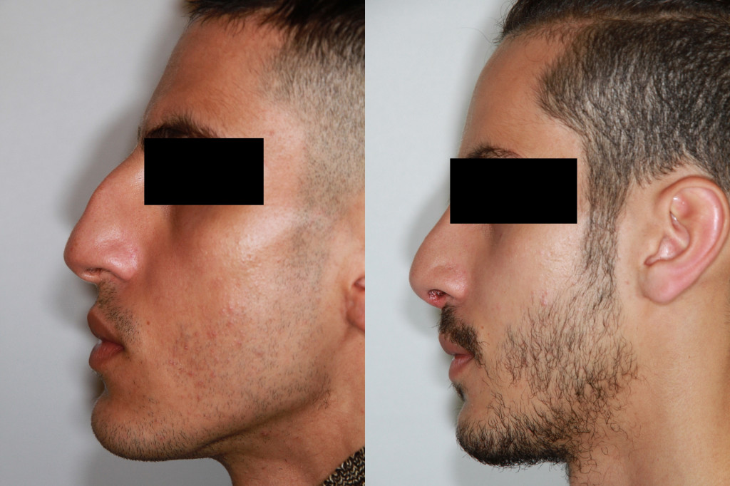 Rhinoplastie Paris 8ème, chirurgie du nez sur Paris | Dr Bergeret-Galley